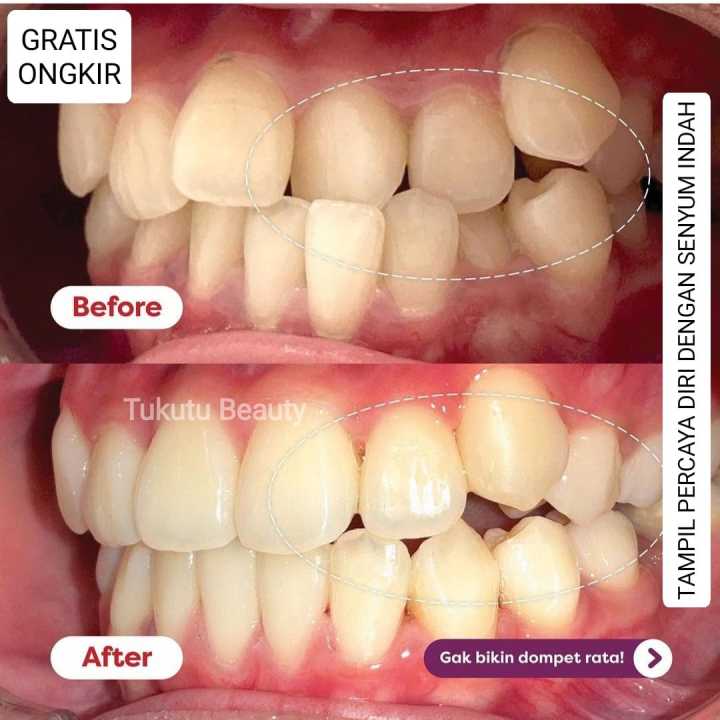 Perapih Gigi Gigi Behel Gigi Gigi Behel Lepas Pasang Kawat Gigi ...