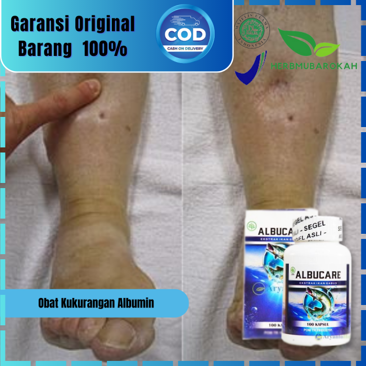 Albucare/Suplemen Peningkat Albumin Dalam Tubuh/Mencegah Gejala ...