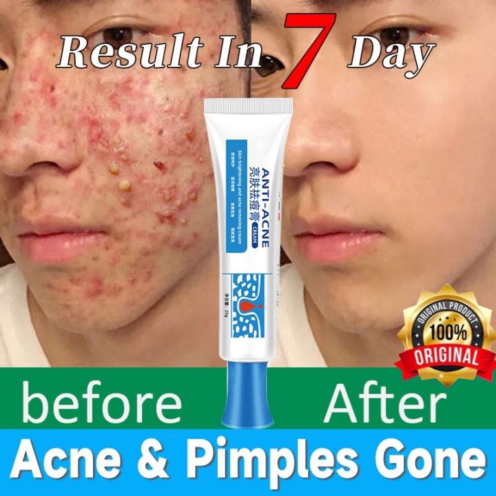 Acne Remover Cream Pimple Marks Remover Cream Acne Treatment Acne Scar ...