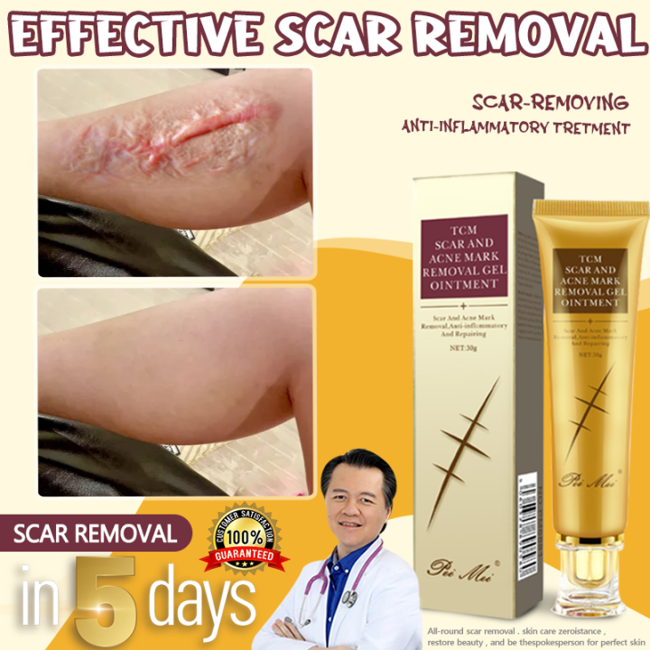 scar gel by doc willie ong fix scar removal original scars remover for ...