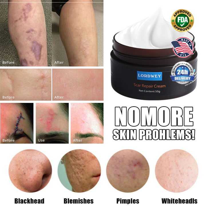 LORDWEY Scar Remover Peklat For Old And New Scar Scarminator Cream ...