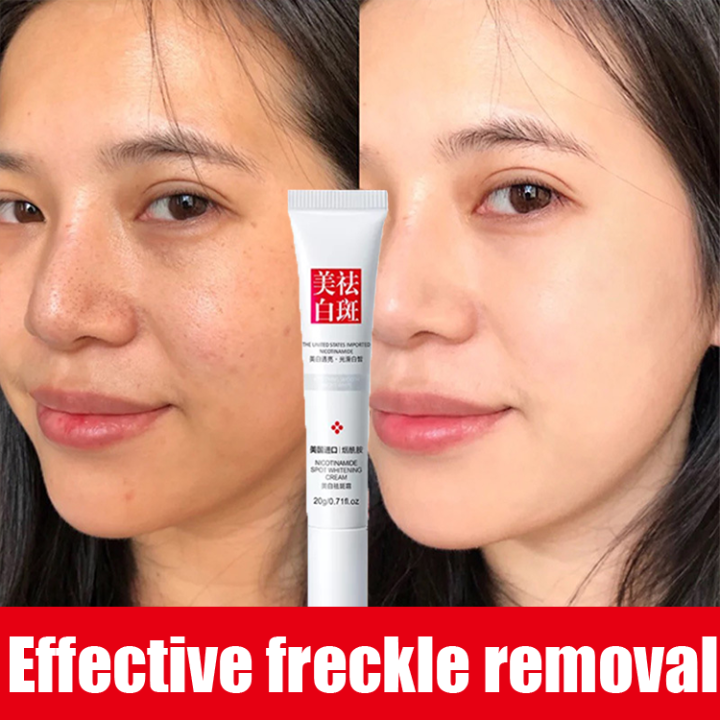 Fast effective freckle removal whitening cream retinol serum for face serum vitamin c & ollagen ...
