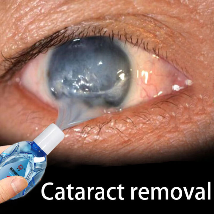Eye Drops for dry eye Cataract eye drops Eye Wash Care Eye Washer Eye ...