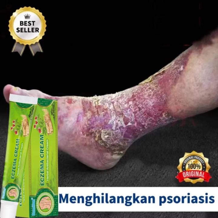 Salep kulit Salep eksim Salep gatal Menghambat infeksi jamur 20g Bahan ...