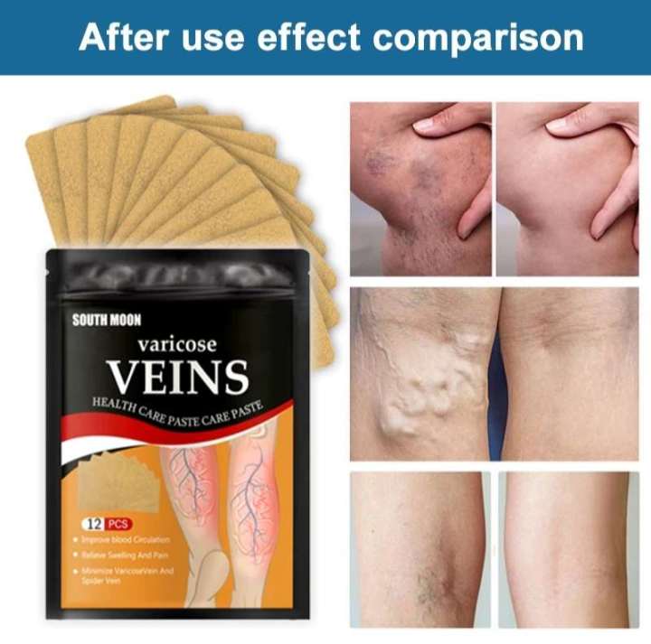 Original and Effective Pain Relief Varicose Veins Plaster Patch 12pcs ...