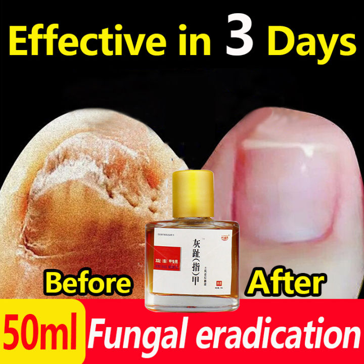 3-day effective Nail Fungus Repair Nail Repair Solution 50ml Quick ...