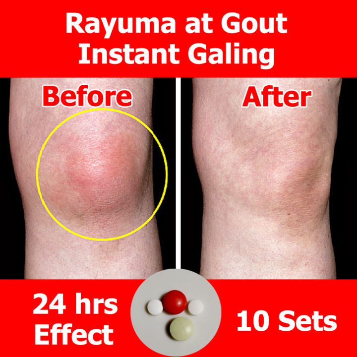 Arthritis Rayuma Gout Relief 10 Sets, Arthritis Medicine, Arthroneo ...