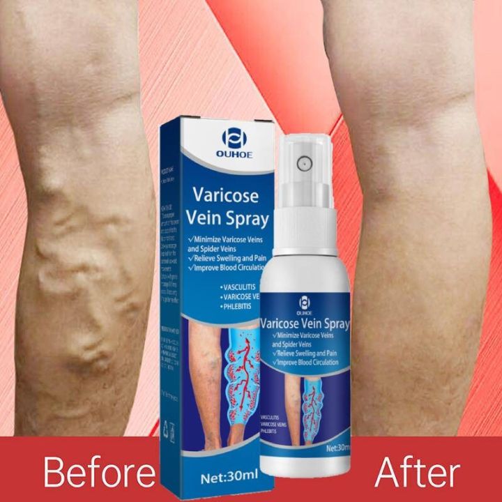 LADES【OUHOE】Varicose Veins Spayer Treatment Essential Oil Relief ...