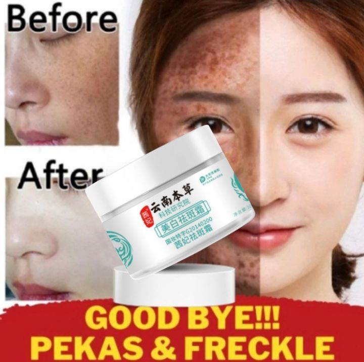 Yunnan Herbal Melasma Cream 30g Melasma Cream Original High ...