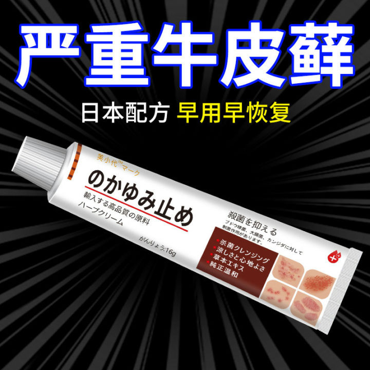 Japanese Tinea of Feet and Hands Tinea Versicolor Tinea Corp Seborrhea Dermatitis Eczema Anti ...