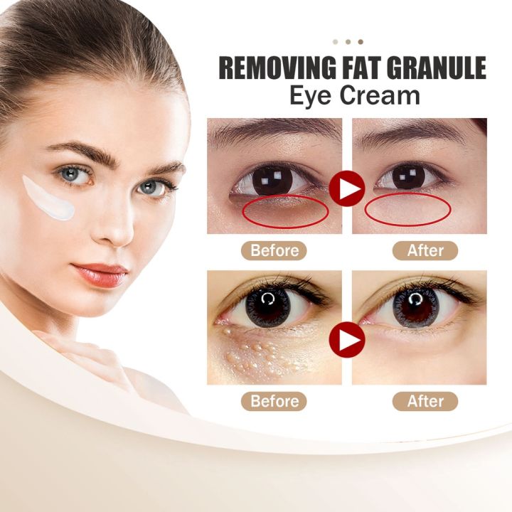 Kem mắt loại bỏ mụn thịt tinh chất nghệ tây saffon 30g | Lazada.vn
