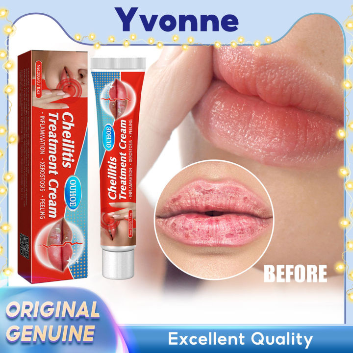 【Hot Sale】OUHOE Cheilitis Treatment Cream Sumifun Cold Sores Lip Cheilitis Treatments Cream ...
