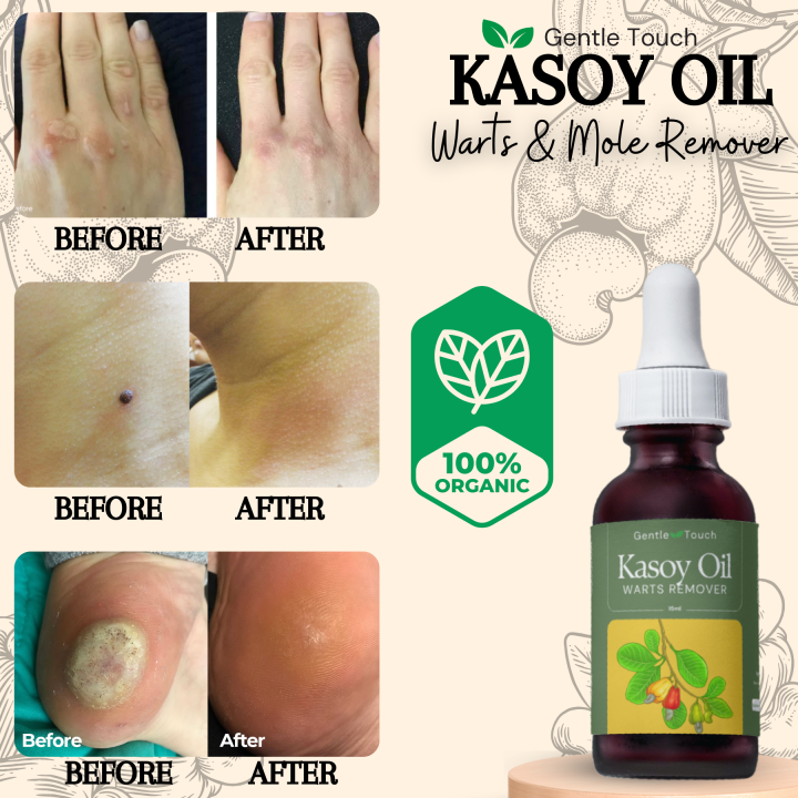 🔥[Gentle Touch] Kasoy Oil(15ml) 🔥infused with Salicylic Acid for ...