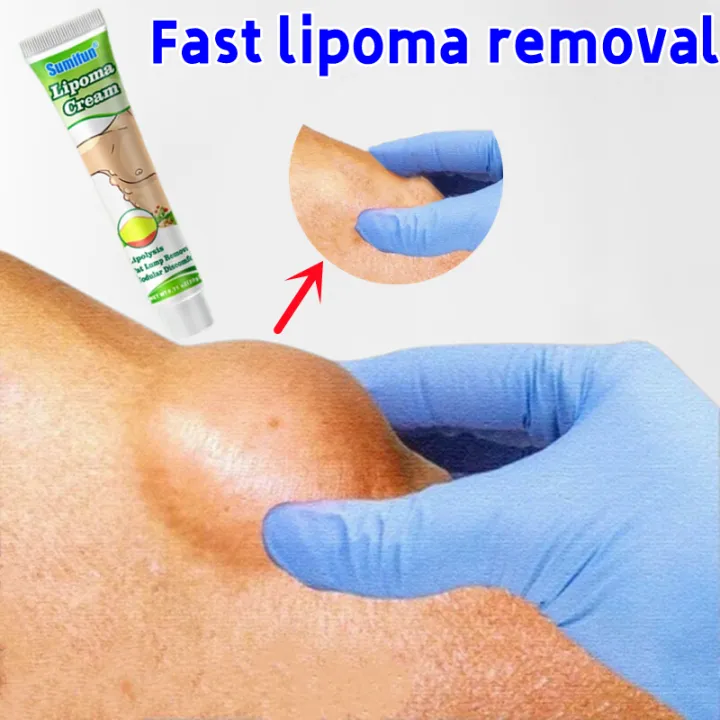 lipoma removal cream krim benjolan Skin Swelling Ointment Fat ...