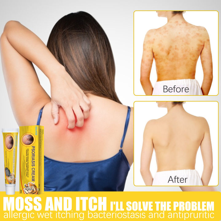Eelhoe Psoriasis Cream Skin Psoriasis Antipruritic Ointment Dermatitis ...