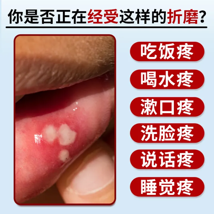Dental ulcer gel special toothpaste paste for children's canker sore ...
