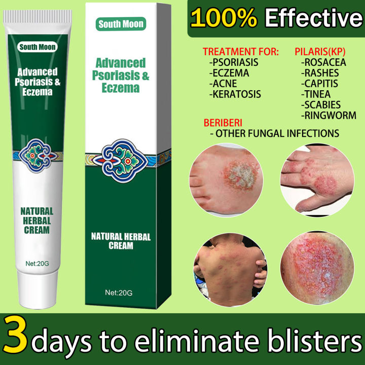 100% efficient Original Natural 20g Herbal Psoriasis Dermatitis Eczema Pruritus Psoriasis Cream ...