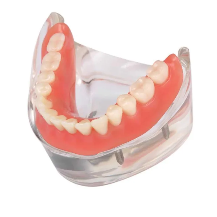 Dental Overdenture Dental Teeth Model Interior Mandibular Lower Teeth ...