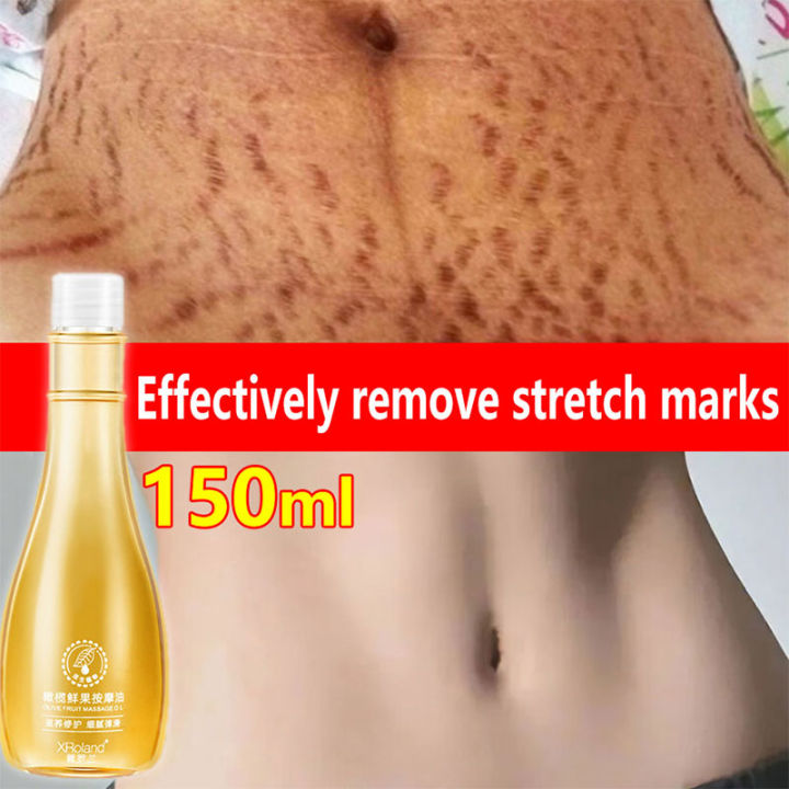 Stretch mark remover 150ml Strechmark removal original effective ...