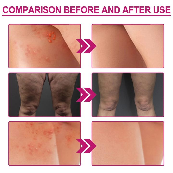 Collagen Buttock Acne Removal Cream Thigh Acne Scar Mark Dark Spot