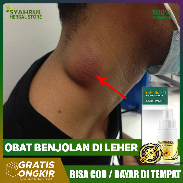 Obat Atasi Kelenjar Getah Bening, Obat Benjolan Limfoma, Obat ...
