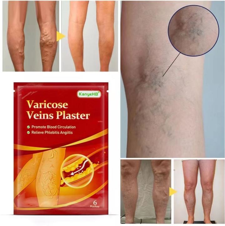 Varicose vein patch pain relief body relievers knee Patches muscle ...