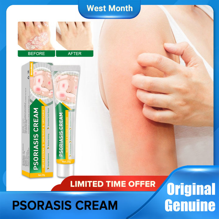 Psoriasis Eczema Cream Itching Cream Dermatitis Cream Eczema Treatment Cream For Feet Anti ...