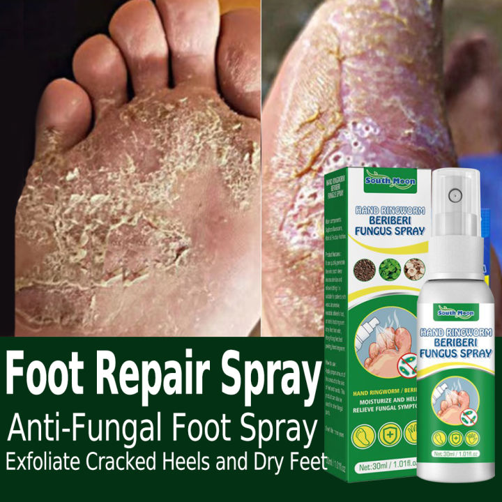 Jaysuing Anti Fungal Athlete Foot Spray Herbal Anti Fungal foot spray ...