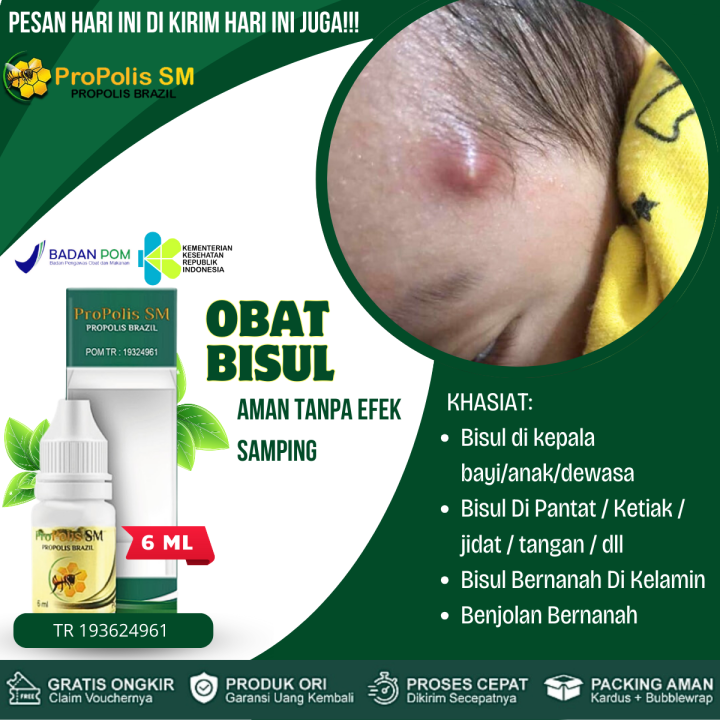 Obat Bisul, Bisul Bernanah, Bisul Di Kepala Bayi / Anak / Dewasa, Bisul ...
