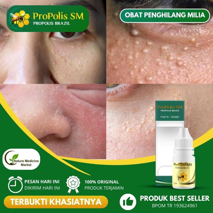 Obat Penghilang Milia, Penghilang Bruntusan Kecil Di Muka, Benjolan ...