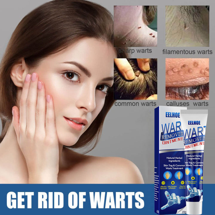warts remover cream original painless 20g Warts Magic Remover Wartz ...