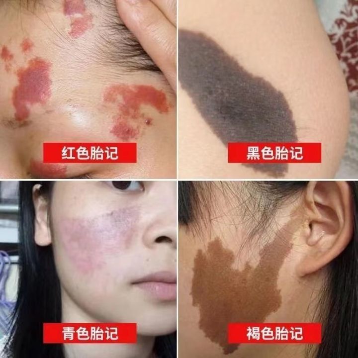 [Quick Birthmark Removal] Birthmark Removal Artifact Removing Melanin ...