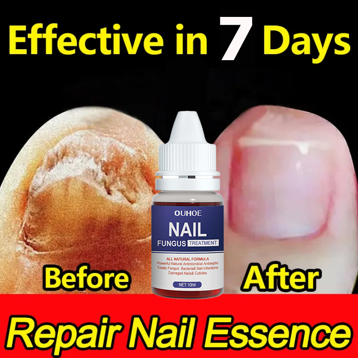 Nail fungus repair Nail repair liquid Quickly repair damaged nails ...