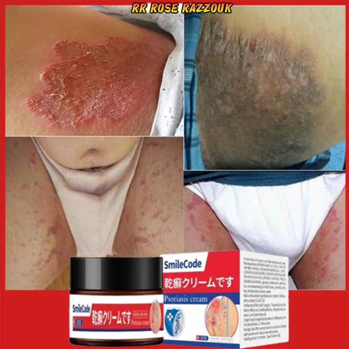 Japanese Psoriasis cream Eczema Anti fungal cream fungisol antifungal cream psoriasis ointment ...