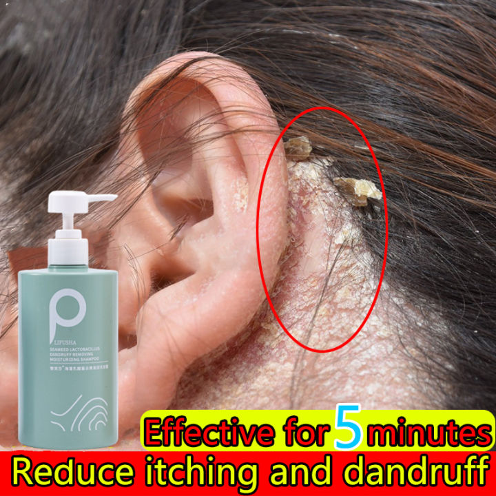 anti dandruff shampoo shampoo kelemumur dandruff treatment oil control ...