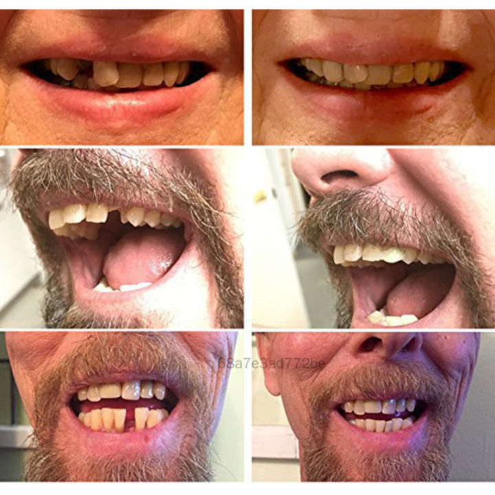 Fake Braces Veneers Dentures Socket Bad Teeth Whitening Alternative ...