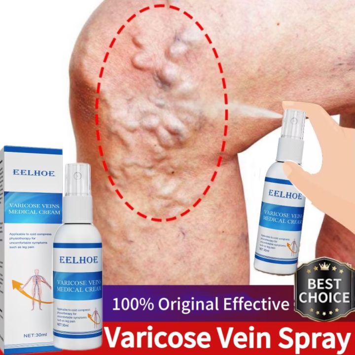 Varicose Vein Treatment Spray 100% Original and Effective 30ML Anti ...