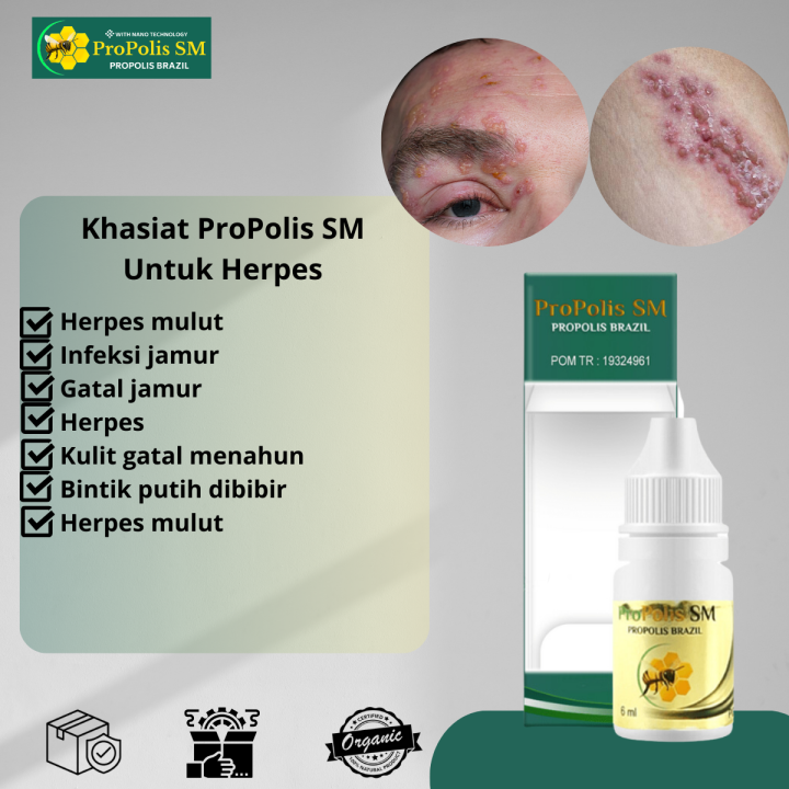 Obat Herpes Kulit Pada Anak dan Dewasa Herpes Genital Kelamin Bentol ...