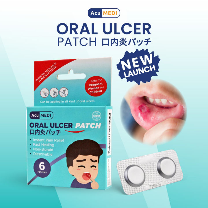 ACUMEDI Tampalan ulcer mulut lulus MDA Oral Ulcer patch with MDA ...