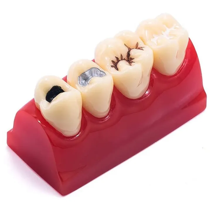 Dental Pathology Teeth Model Sealant Demonstration Tooth Model for ...