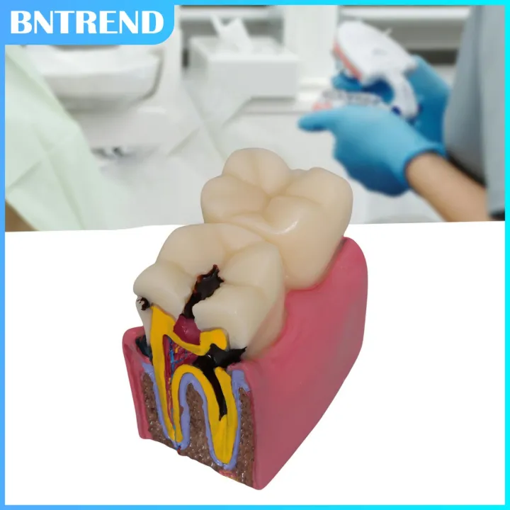 BNTREND 6 Times Morphology Tooth Decay Model for Patients Students ...