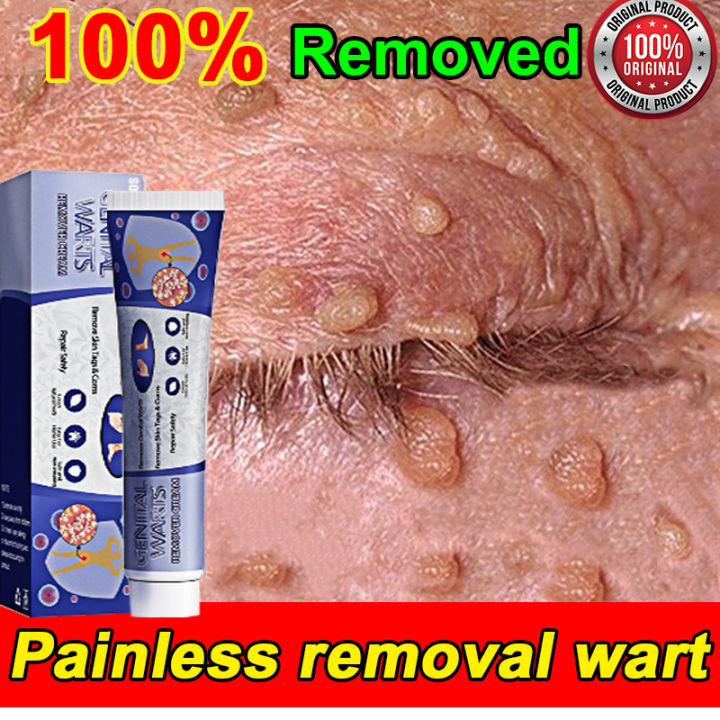 wart remover cream ubat ketuat tahi lalat ubat kutil skin tag remover ...