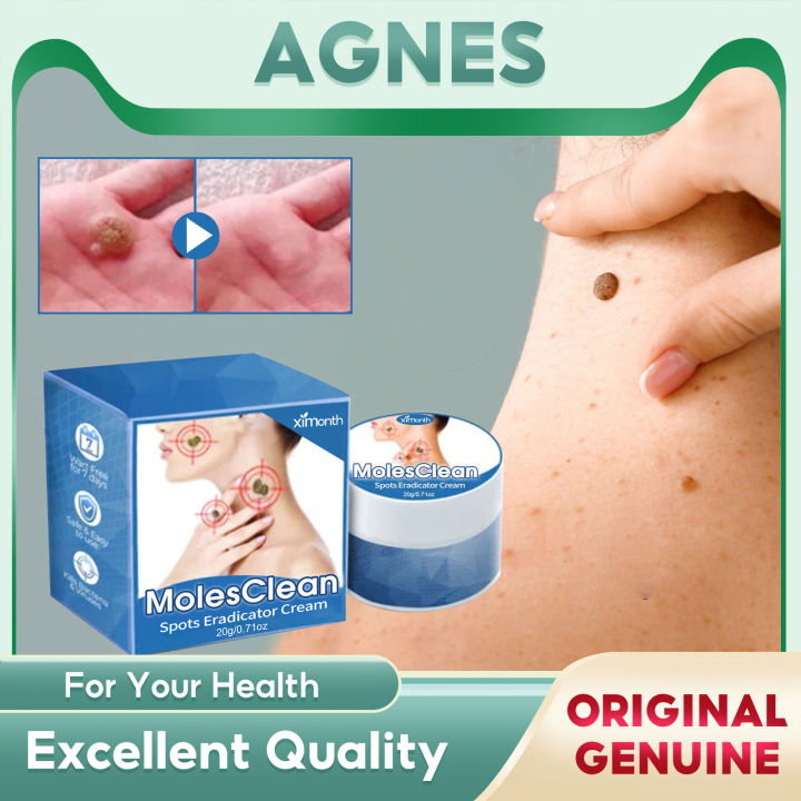 Ximonth Moles Clean Spots Eradicator Cream Remove Warts From The Skin ...