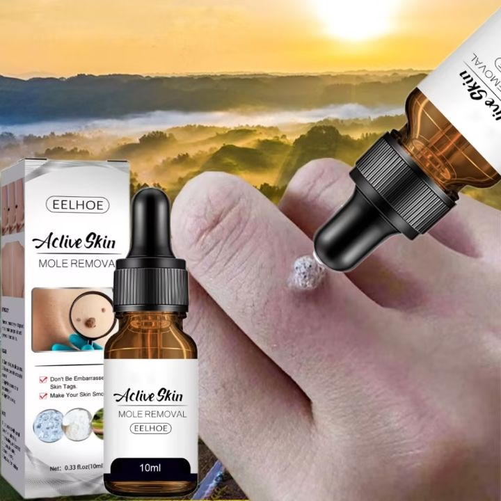 Warts Remover Pure Kasoy Oil Warts Remover Original Mole Remover Kulogo ...