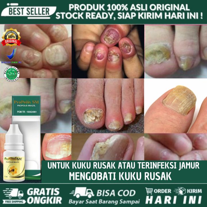 Obat Herbal Kuku Rusak Berjamur Jamur Kaki Tangan Cantengan Bau ...