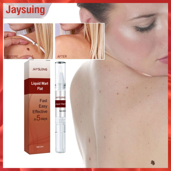 Jaysuing Liquid Warts Flat Eliminate Wart Pen Wart Liquid Hand Foot Warts Remove Filiform Flat ...