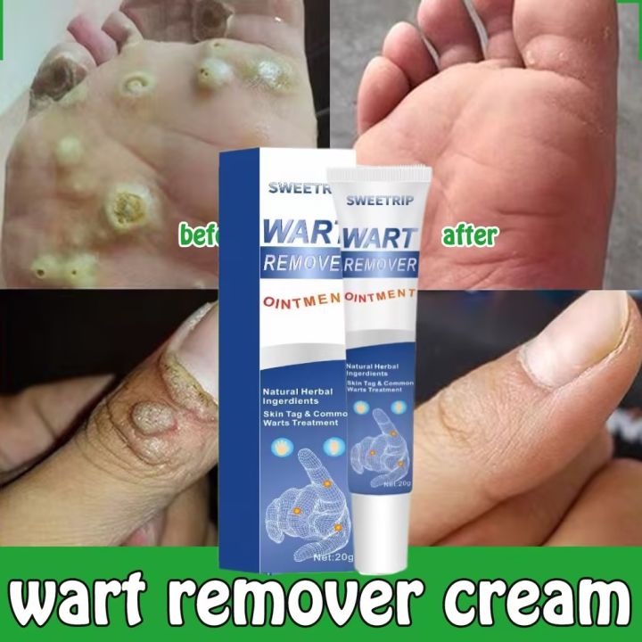 Warts Remover Original Cream 7 days Effective Warts Warts Magic Remover ...