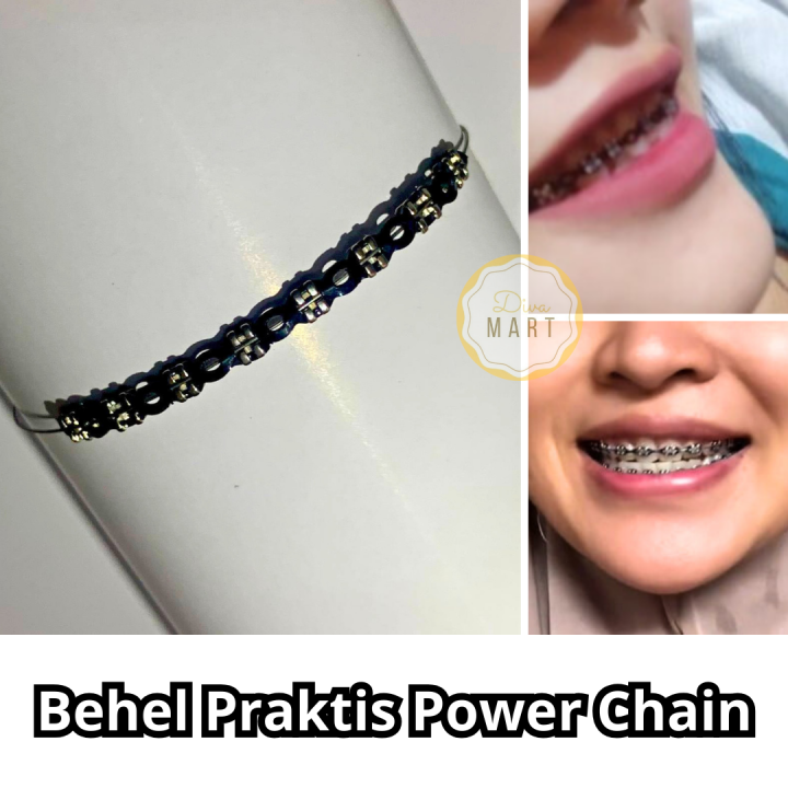 Behel Gigi Bisa Lepas Pasang Sendiri Power Chain Hitam Atas Bawah ...