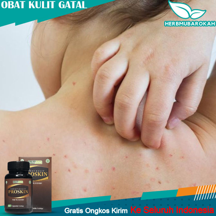 Obat Kulit Gatal - Biduran - Kaligata - Bentol - Ruam - Gatal Alergi ...