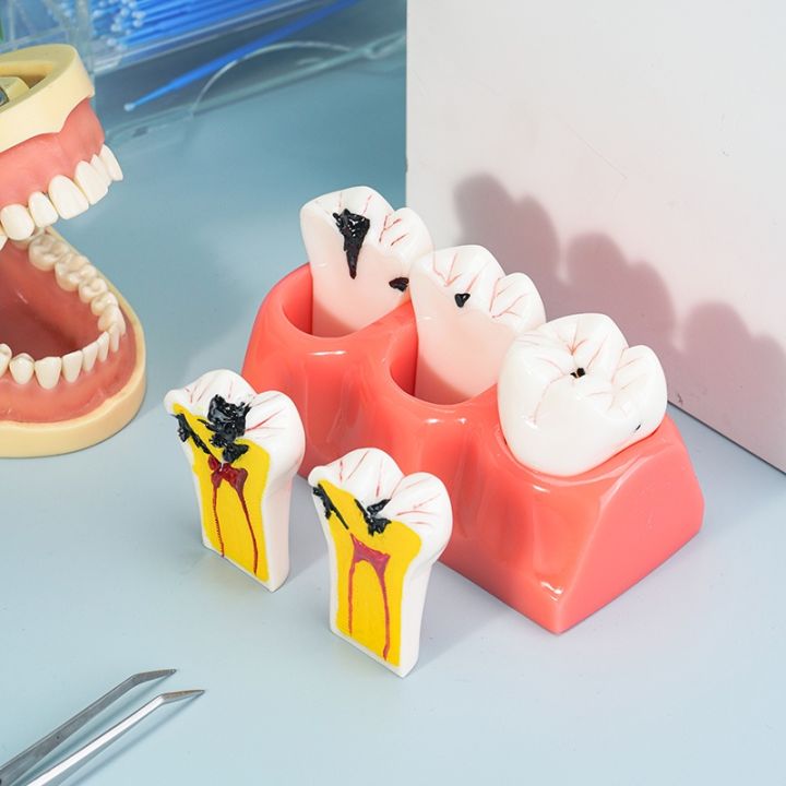 4 Times Dental Anatomy Education Teeth Model Caries Comparation Study ...